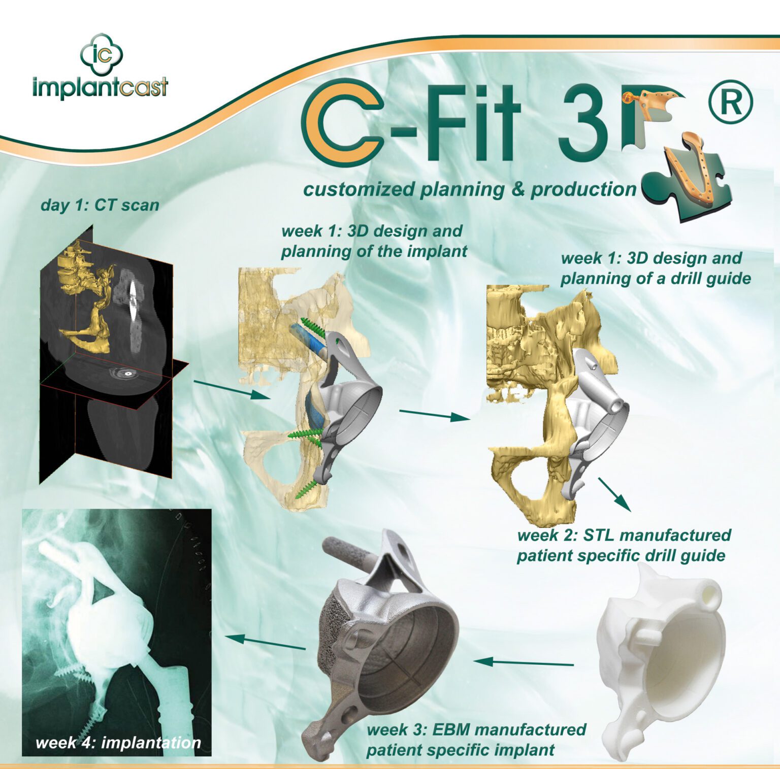 Custom Orthopedic Implants | Implantcast North America