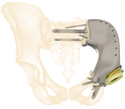 Custom Orthopedic Implants | Implantcast North America